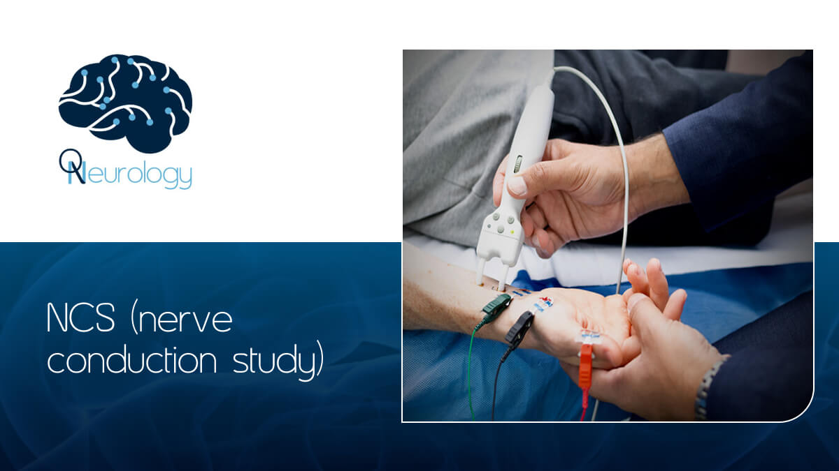 Nerve Conduction Study (NCS) | QNeurology